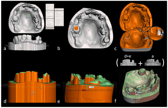 3D-Printed Overlay Template for Diagnosis and Planning Complete Arch ...