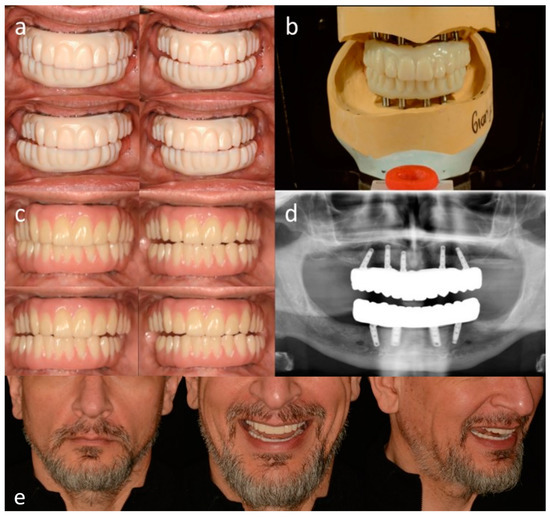 3D-Printed Overlay Template for Diagnosis and Planning Complete Arch ...