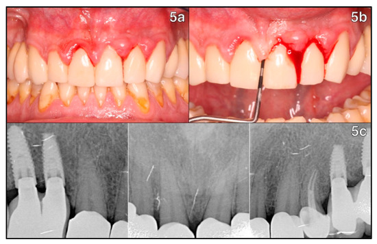 Periodontal Healing with Fixed Restorations Using the Biologically ...