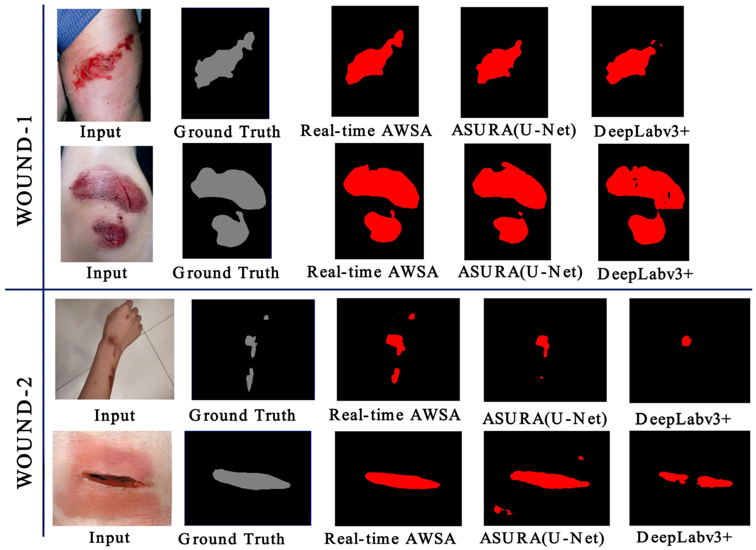 Convolution Neural Network with Coordinate Attention for Real-Time Wound Segmentation and ...