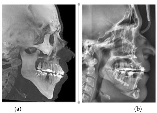 Managing Predicted Post-Orthognathic Surgical Defects Using Combined ...