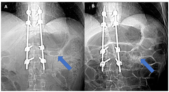 A Rare Case of Severe Diarrhea: Gastrocolic Fistula Caused by Migration ...