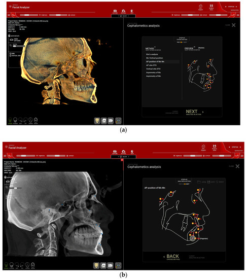 Intraindividual Left–Right Side Differences of Sagittal Condylar ...