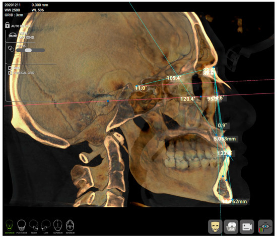 Intraindividual Left–Right Side Differences of Sagittal Condylar ...