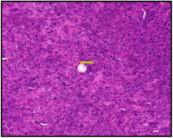 The First Case of Human Hepatic Fasciolosis Presented as Hepatic ...