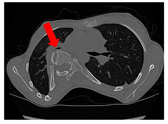 Imaging Methods to Quantify the Chest and Trunk Deformation in ...