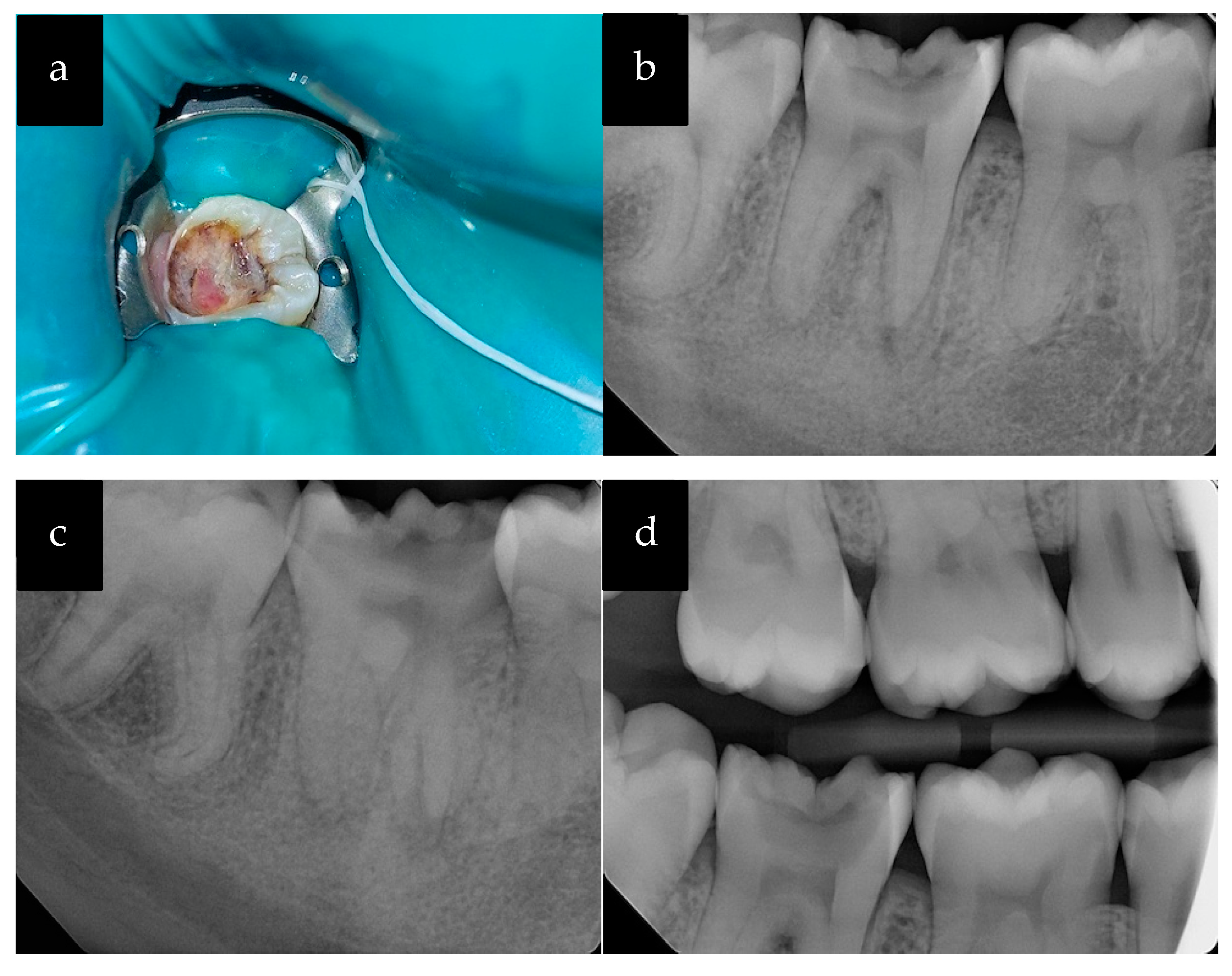 Endodontic Management of Three-Rooted Mandibular Second Molar with ...