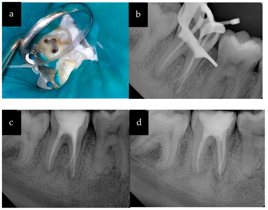 Endodontic Management of Three-Rooted Mandibular Second Molar with ...