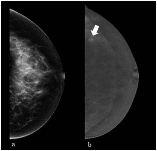 History of Mammography: Analysis of Breast Imaging Diagnostic ...