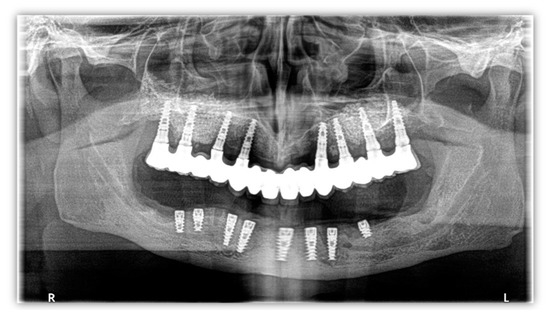 Advanced Techniques for Bone Restoration and Immediate Loading after ...