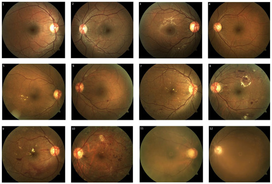 Healthcare | Free Full-Text | Variability in Grading Diabetic Retinopathy Using Retinal ...
