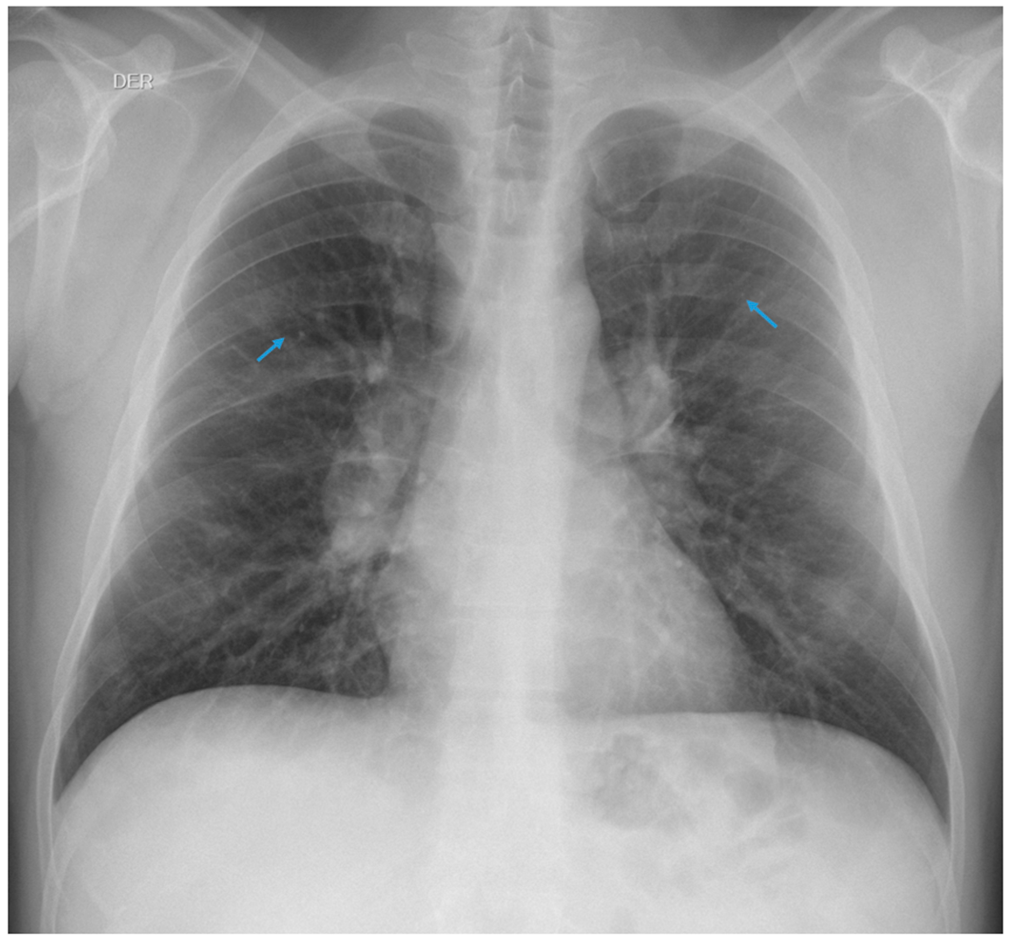 Silicosis Lung