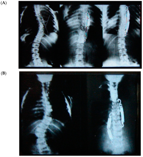 Posterior Vertebral Pedicular Tethering for the Treatment of Idiopathic ...