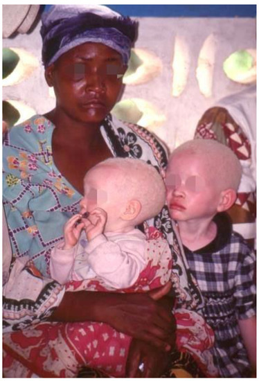 Human Skin Pigmentation: From a Biological Feature to a Social Determinant