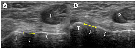 Ultrasound Imaging of Subtalar Joint Instability for Chronic Ankle ...