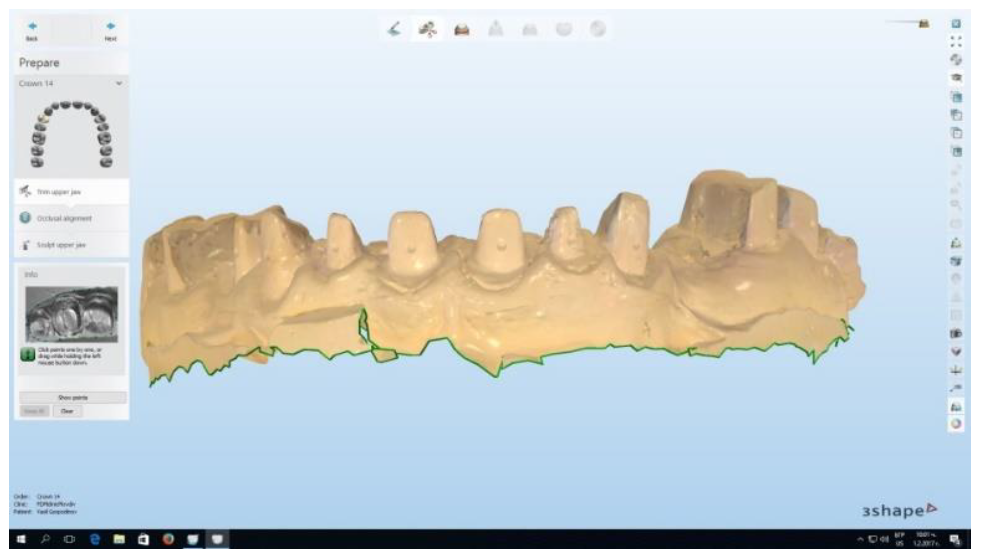 A Comparative Analysis of Post-Retraction Changes in Gingival Height ...