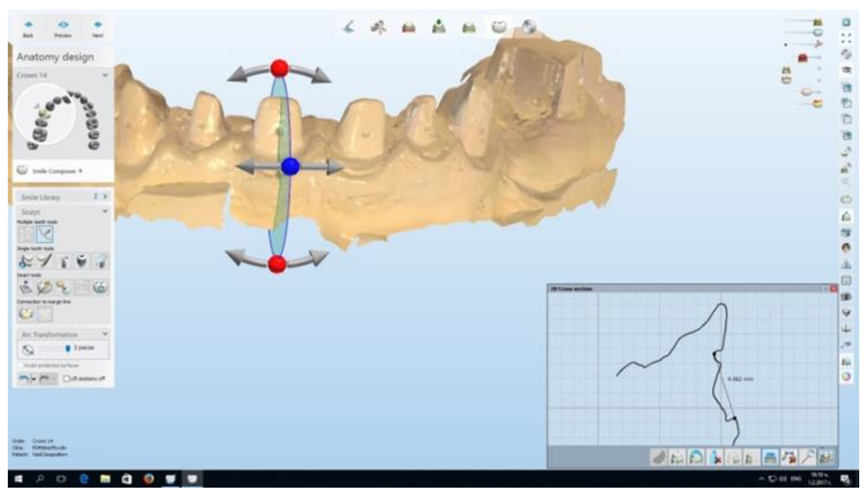 A Comparative Analysis of Post-Retraction Changes in Gingival Height ...