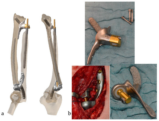 Missed Essex-Lopresti Injury—Development of a Combined Proximal and ...
