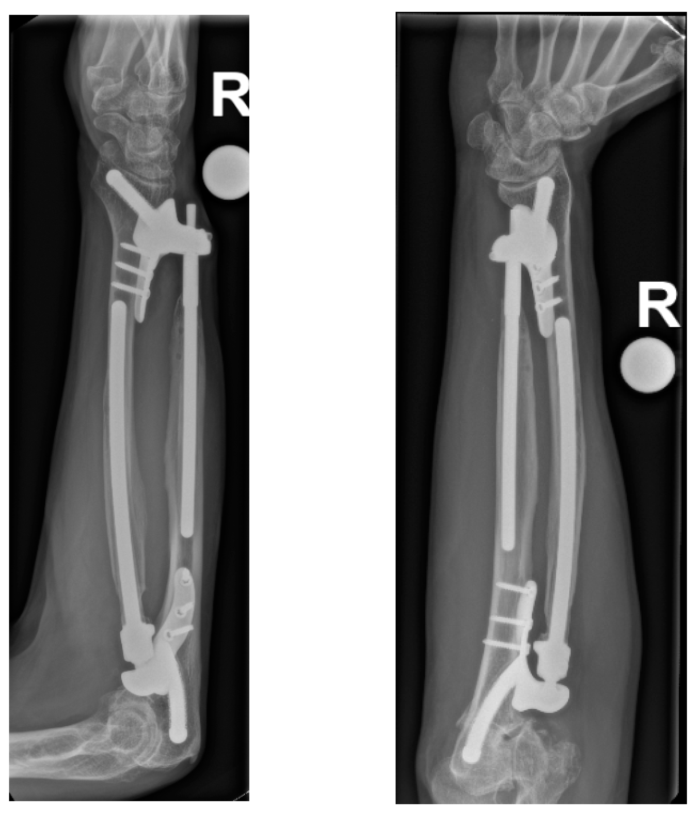 Missed Essex-Lopresti Injury—Development of a Combined Proximal and ...
