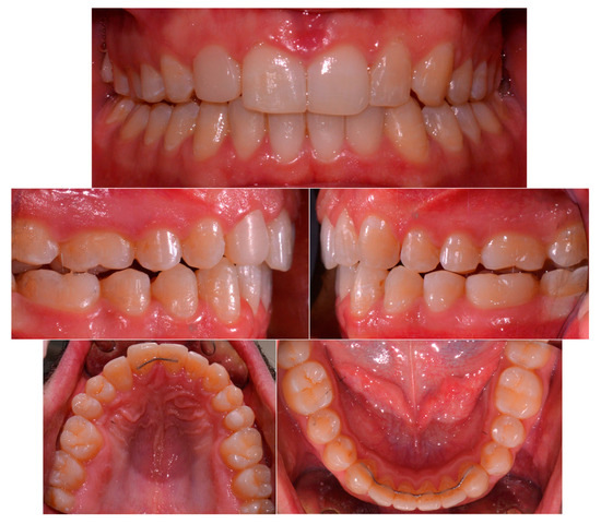 Maxillary Impacted Canine and Upper Lateral Incisor Agenesis Treatment ...