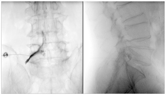 Spinal Injections: A Narrative Review from a Surgeon’s Perspective