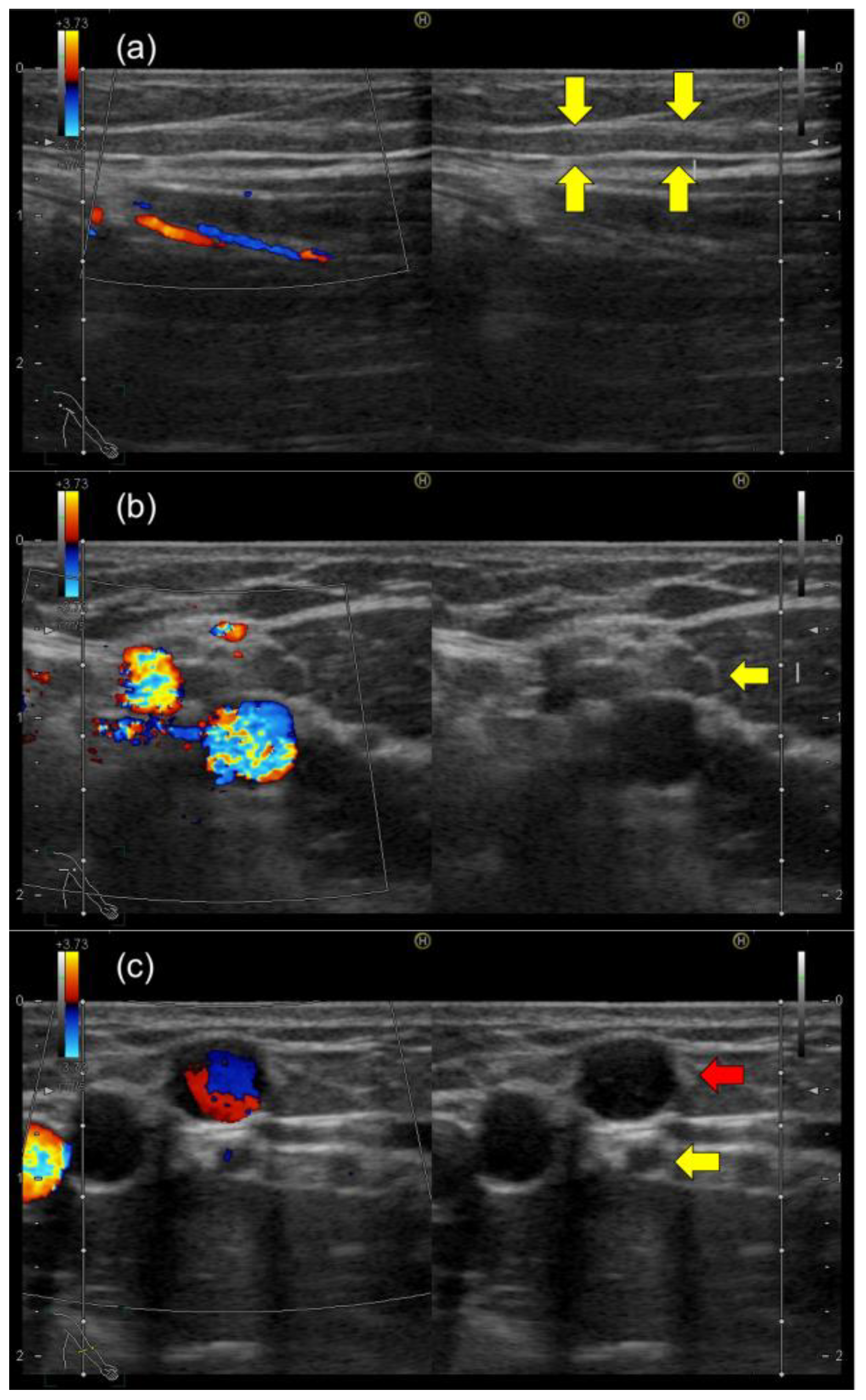 A Case of Axillary Web Syndrome Caused by Venous Blood Sampling