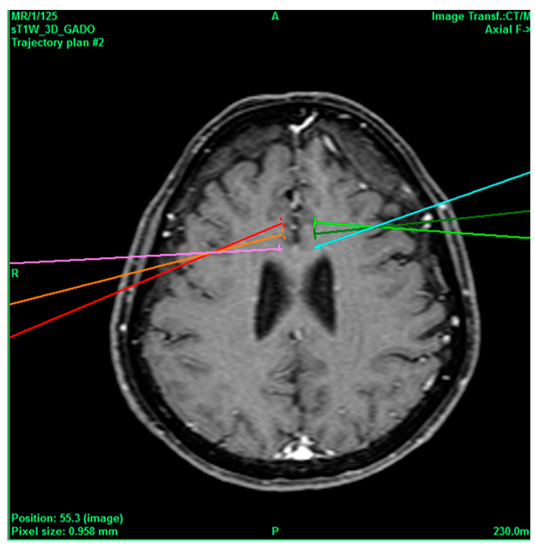 Radiofrequency Cingulotomy as a Treatment for Incoercible Pain: Follow ...