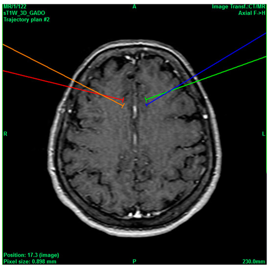Radiofrequency Cingulotomy as a Treatment for Incoercible Pain: Follow ...