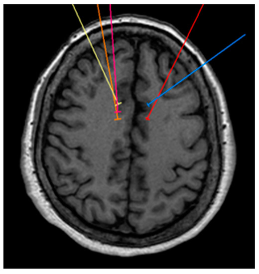 Radiofrequency Cingulotomy as a Treatment for Incoercible Pain: Follow ...