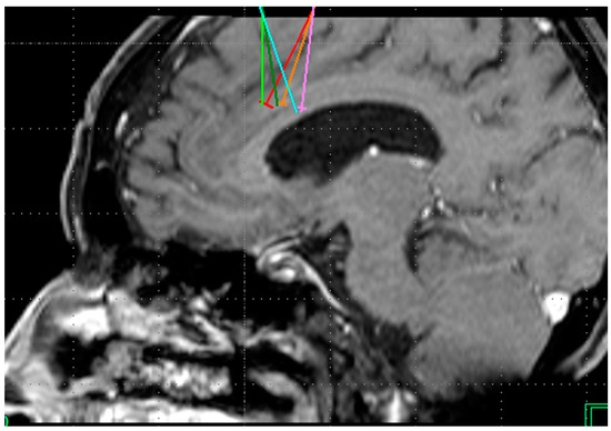 Radiofrequency Cingulotomy as a Treatment for Incoercible Pain: Follow ...