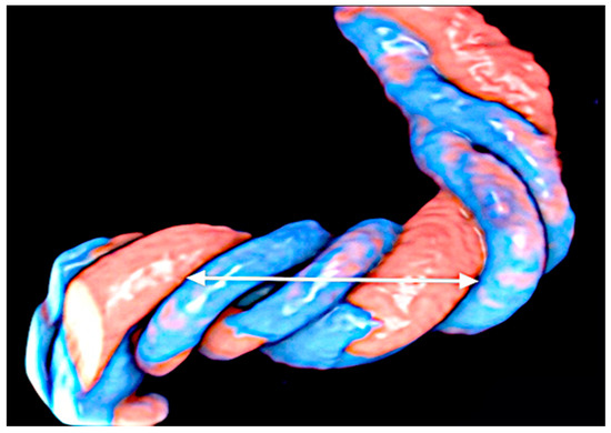 Umbilical Cord Diseases Affecting Obstetric and Perinatal Outcomes