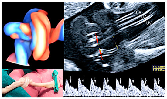 Umbilical Cord Diseases Affecting Obstetric and Perinatal Outcomes