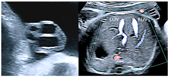 Umbilical Cord Diseases Affecting Obstetric and Perinatal Outcomes