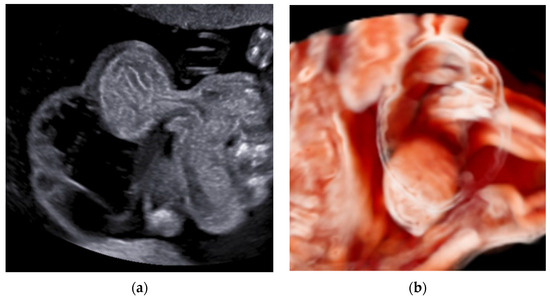 Umbilical Cord Diseases Affecting Obstetric and Perinatal Outcomes