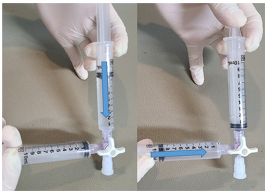 Right-to-Left Shunt Evaluation in Cardiac Patent Foramen Ovale Using ...