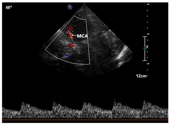 Right-to-Left Shunt Evaluation in Cardiac Patent Foramen Ovale Using ...