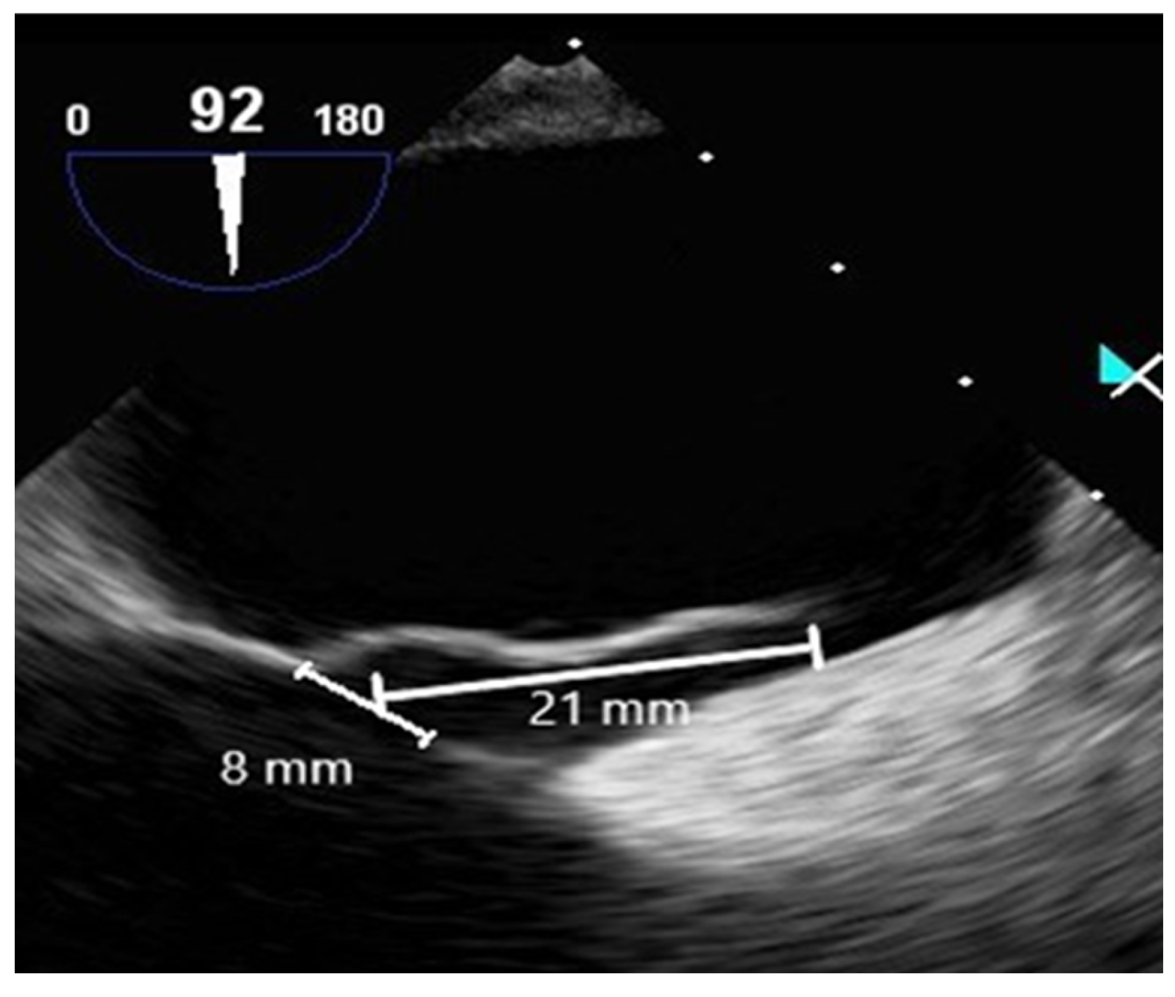 Right-to-Left Shunt Evaluation in Cardiac Patent Foramen Ovale Using ...