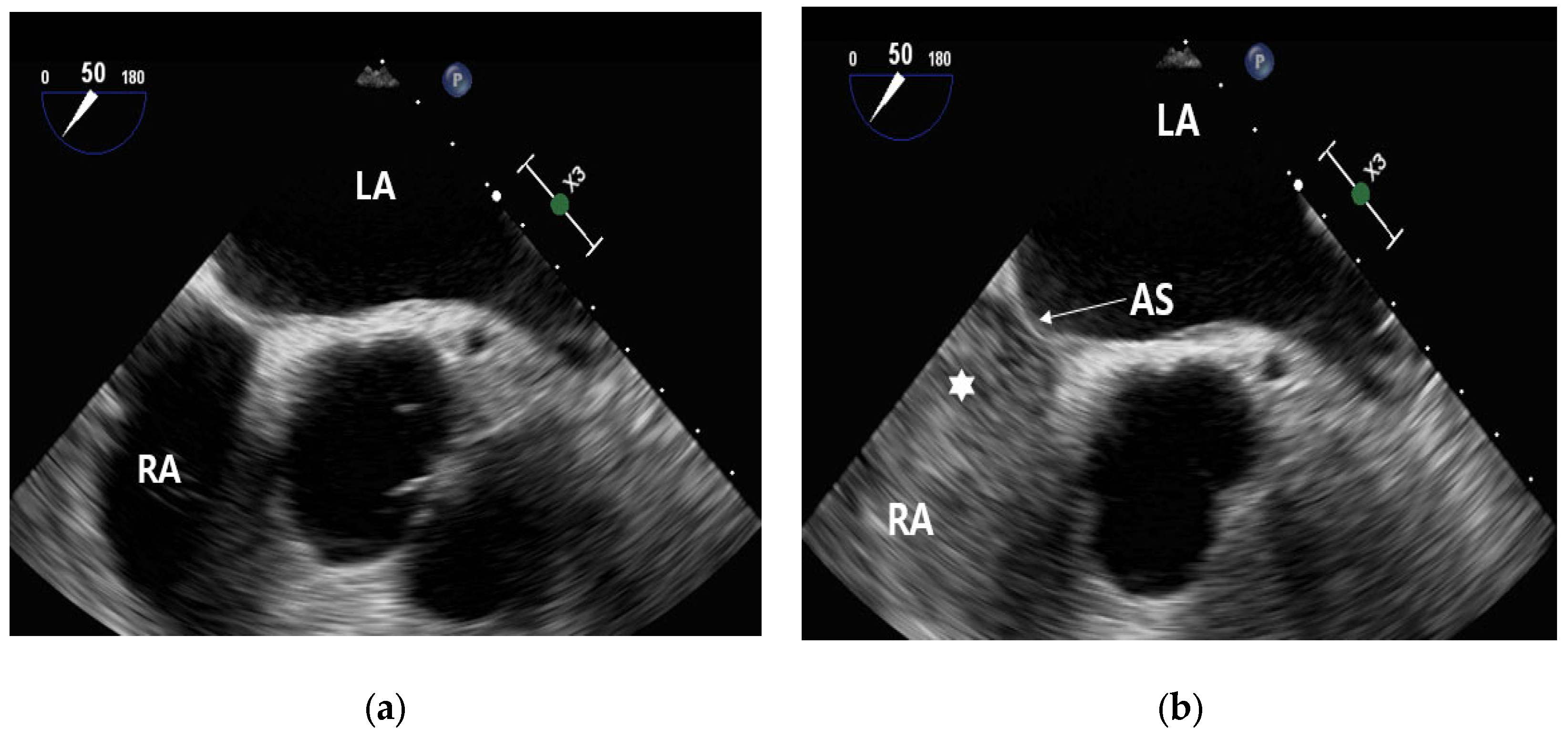 Right-to-Left Shunt Evaluation in Cardiac Patent Foramen Ovale Using ...