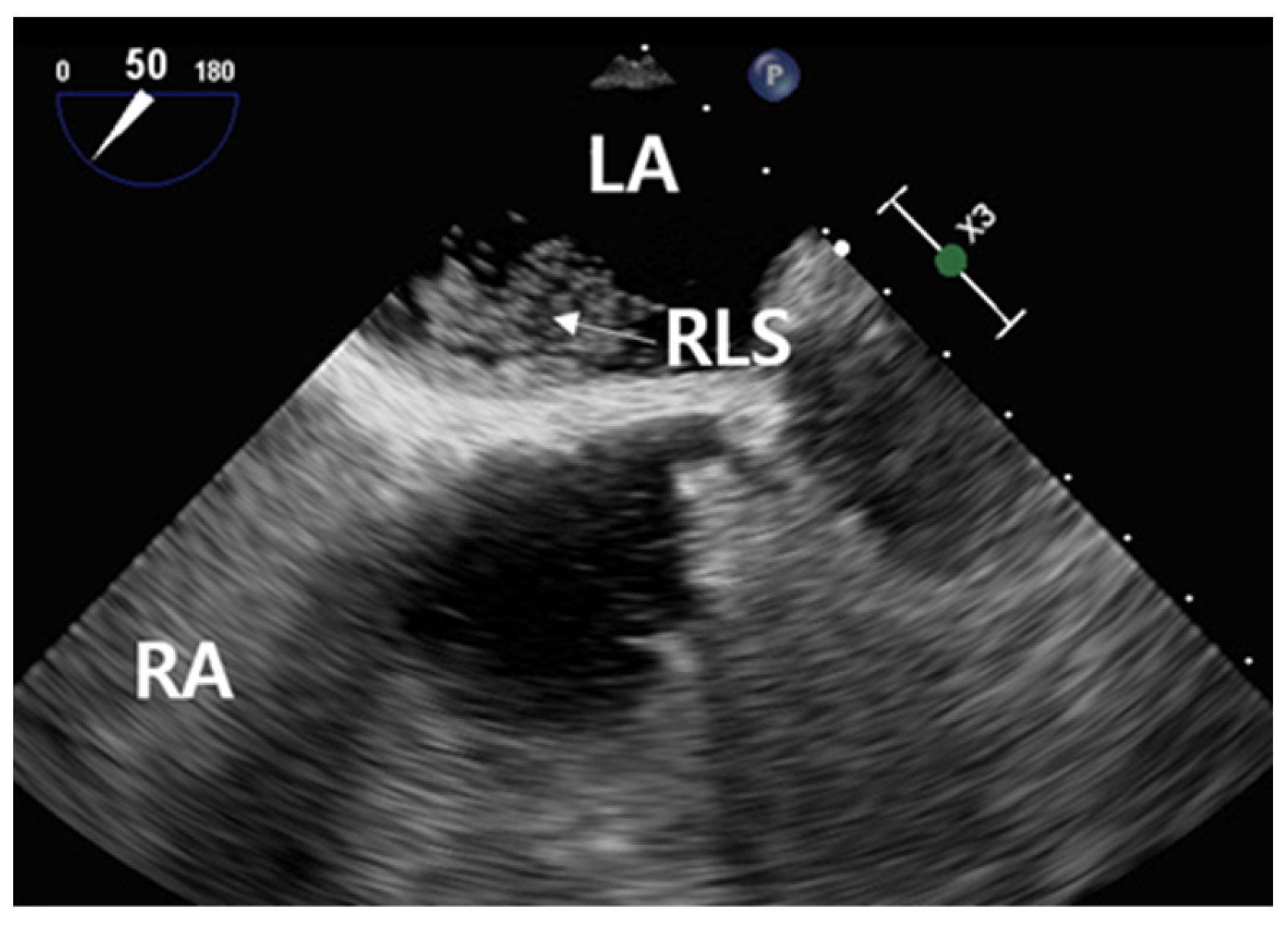 Right-to-Left Shunt Evaluation in Cardiac Patent Foramen Ovale Using ...