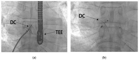 Right-to-Left Shunt Evaluation in Cardiac Patent Foramen Ovale Using ...