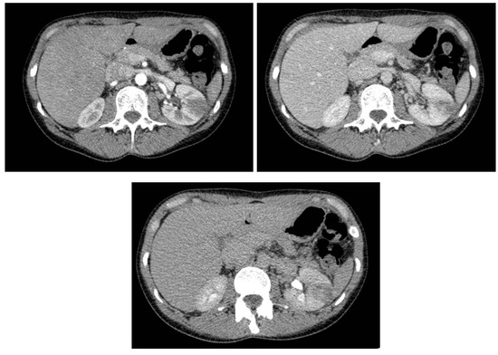 Contrast-Enhanced Ultrasound Follow-Up for Acute Pyelonephritis Patients