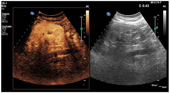 Contrast-Enhanced Ultrasound Follow-Up for Acute Pyelonephritis Patients