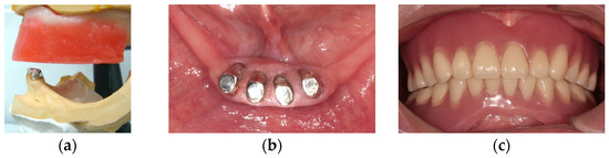 Anterior Hyperfunction by Mandibular Anterior Teeth: A Narrative Review