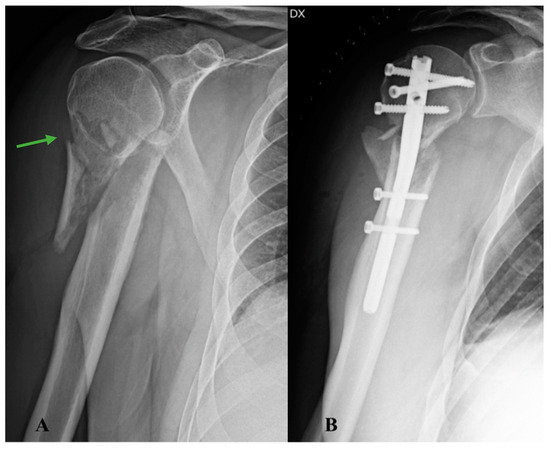Pathological Fracture of the Proximal Humerus Occurred on Metastases of ...