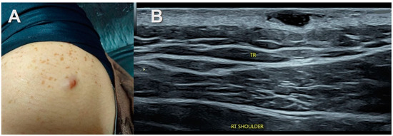 A Retrospective Analysis of High Resolution Ultrasound Evaluation of ...
