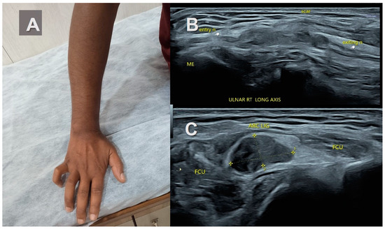 A Retrospective Analysis of High Resolution Ultrasound Evaluation of ...