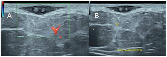 A Retrospective Analysis of High Resolution Ultrasound Evaluation of ...
