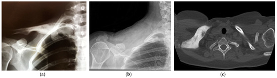 Garrè Sclerosing Osteomyelitis of the Clavicle: Clinical Results after ...