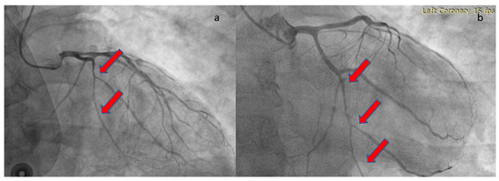 Spontaneous Coronary Artery Dissection as a Cause of Acute Myocardial ...