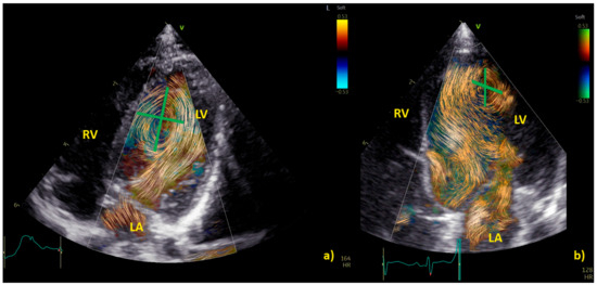 Four-Dimensional Flow Echocardiography: Blood Speckle Tracking in ...
